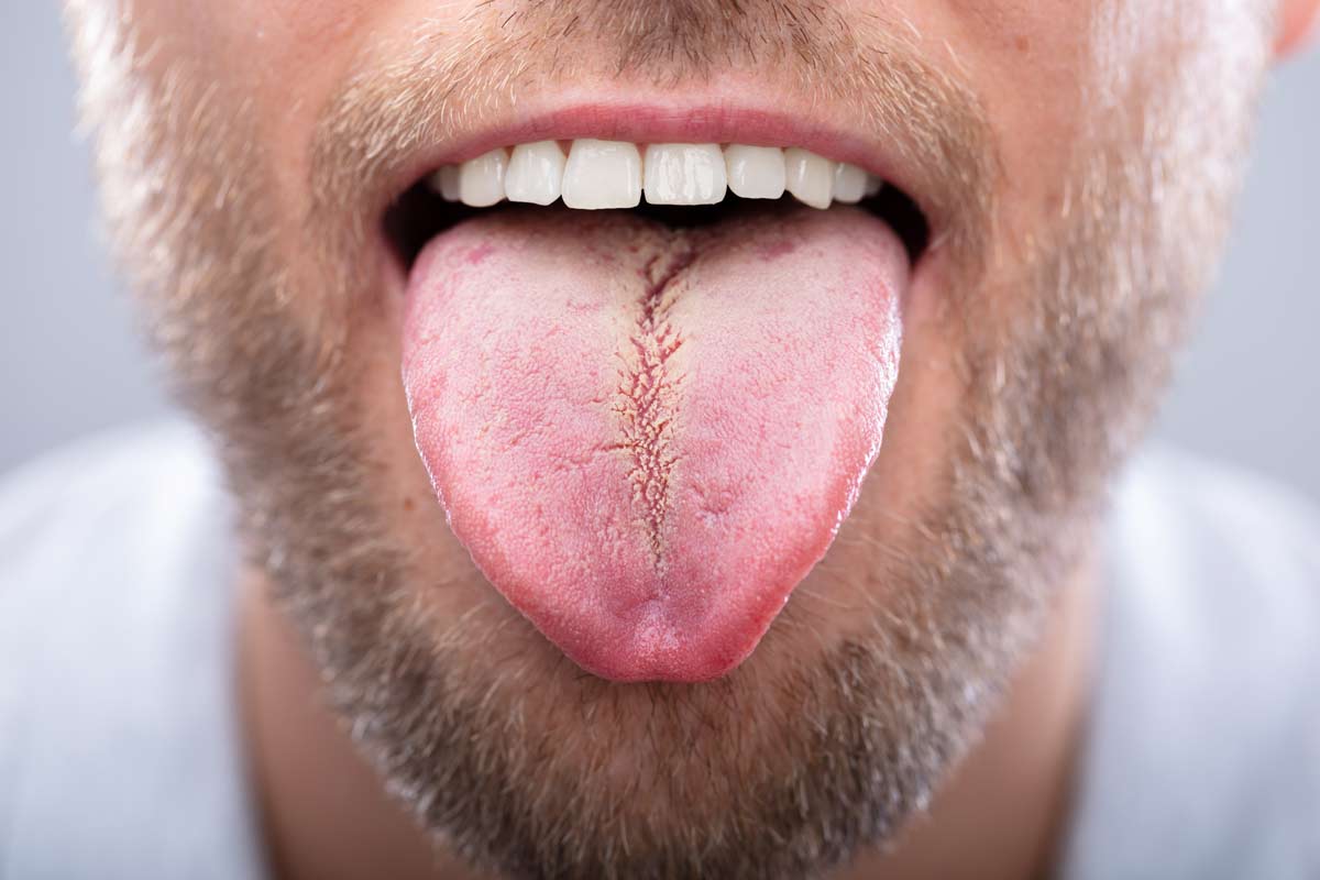 Lengua Amarilla Causas Y Tratamientos BUCAL ORG Lengua Amarilla Causas Y Tratamientos BUCAL ORG