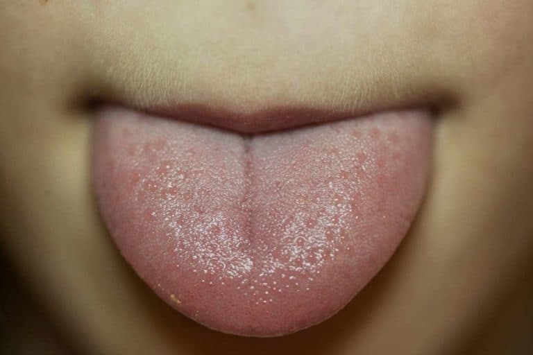 Granos en la Lengua Por qué Salen Cura y Remedios - BUCAL.ORG